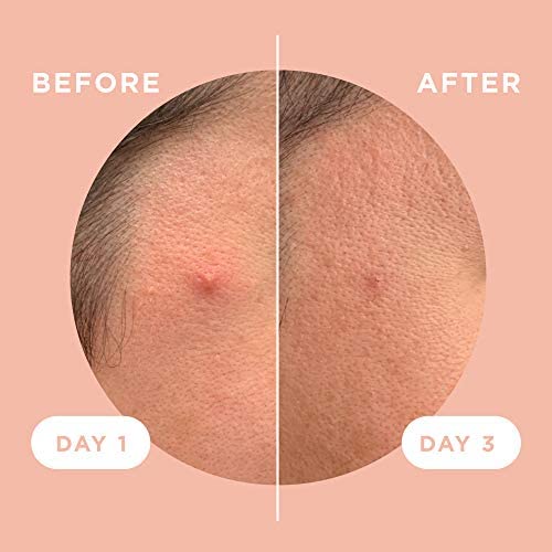 ZitSticka Killa Acne Patches for Face - World's Most Potent Pimple ...